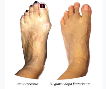 Specialista Alluce valgo Genova, Savona, Alessandria